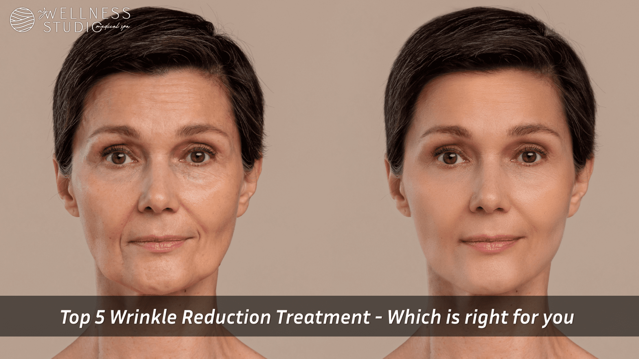 Top 5 Wrinkle Reduction Treatment - Which is right for you
